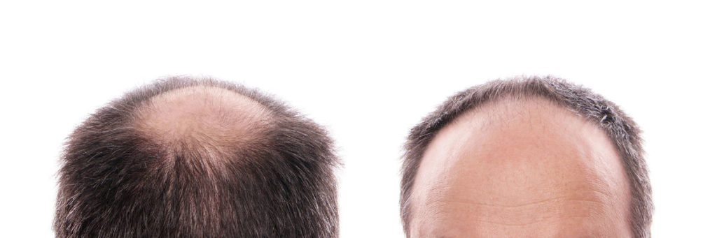 Receding Hairline: Stages, Causes, Prevention & Treatments