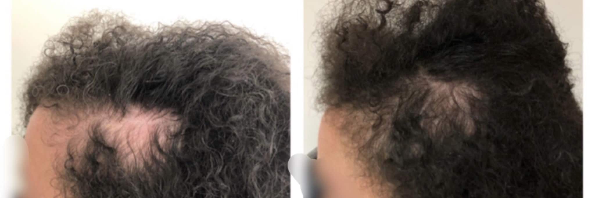 Alopecia: Types. Causes, Symptoms & Treatment Options