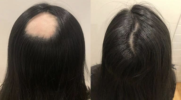 Alopecia: Types. Causes, Symptoms & Treatment Options