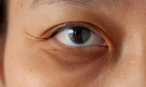 What Causes Dark Circles Under Your Eyes?
