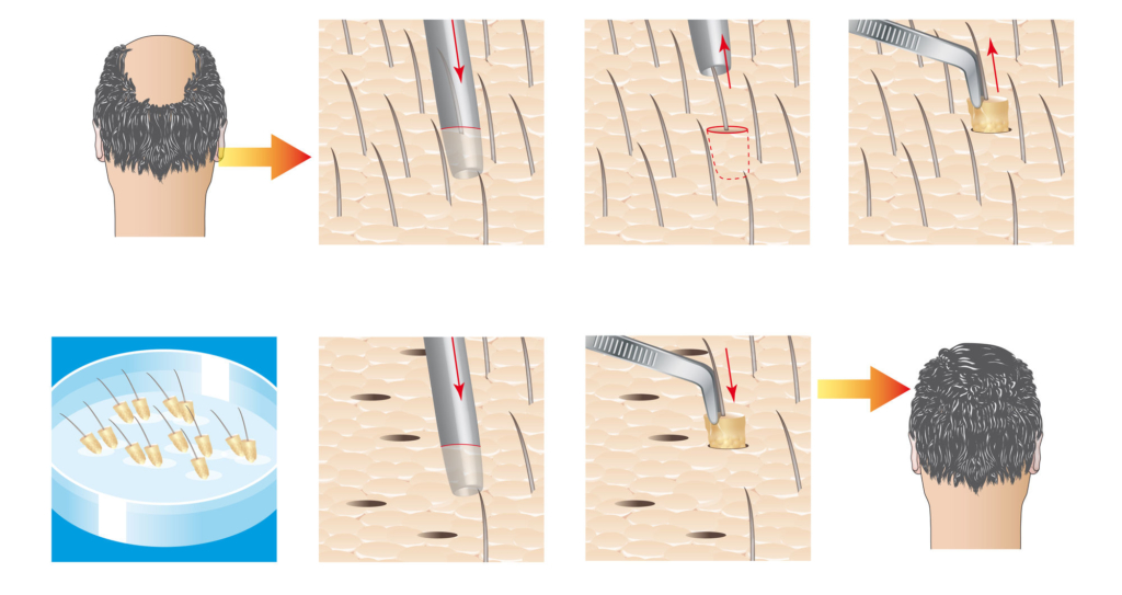 The Ultimate Guide To Hair Transplants In Australia