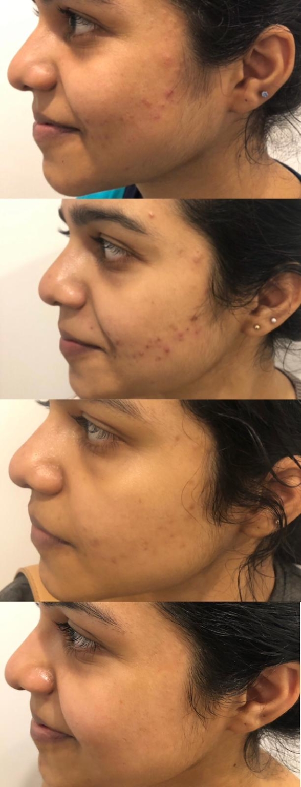 PRP Before and After Results