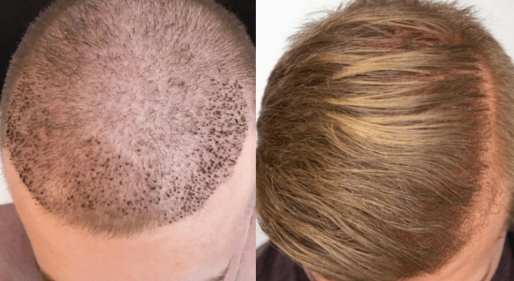 FUE Hair Transplant Recovery Timeline: Month-by-Month Results